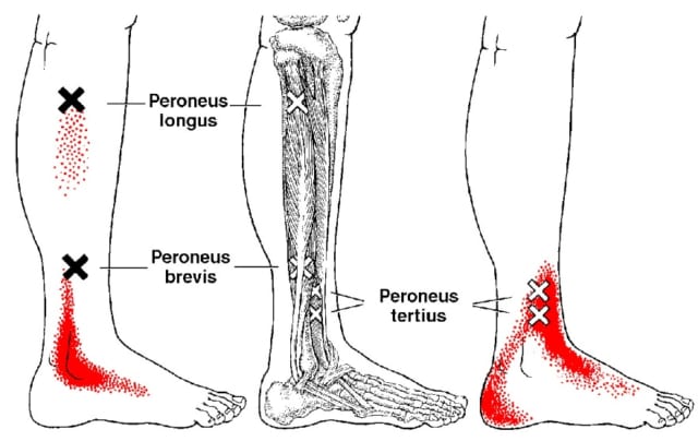 ヘルニア・狭窄症・坐骨神経痛 しつこい足の痛み・しびれを改善するには『すねの外側』をゆるめる【川口陽海の腰痛改善教室 第29回】 | サライ ...